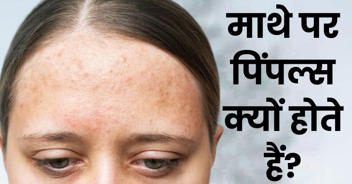 Mathe Par Pimple Hone Ke Karan | माथे पर एक्ने होने के क्या कारण हो ...