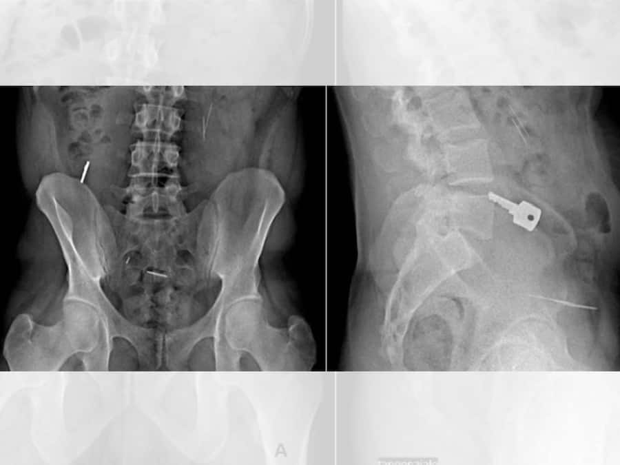 How Foreign Body Ingestion Impacts Children's Health: Warning Symptoms ...