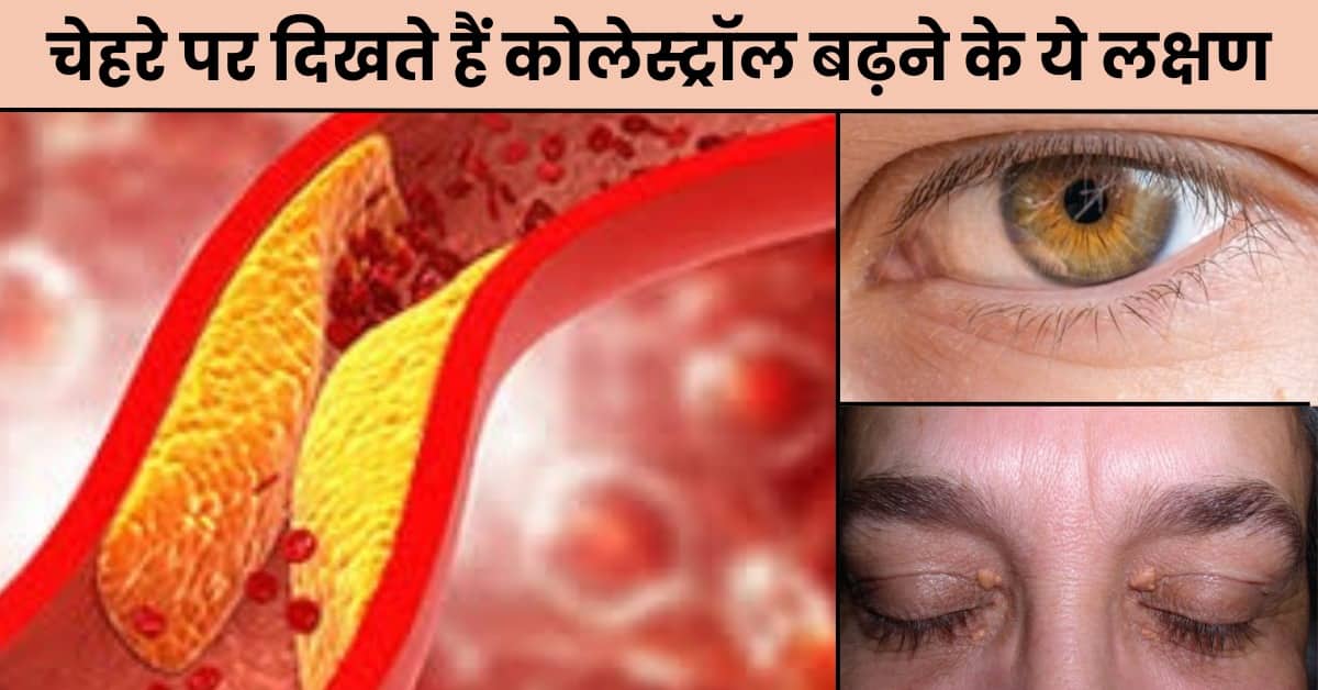 Cholesterol Ke Lakshan | चेहरे पर दिखाई दें ये 5 लक्षण तो समझ जाएं बढ़ ...