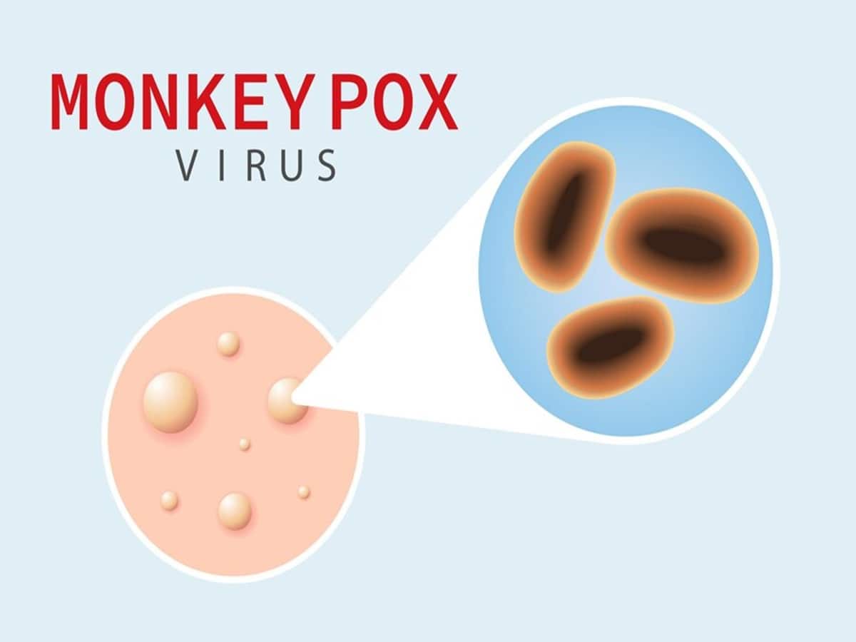 Hyderabad On Alert For Monkeypox: How Many Varieties Of Mpox Are There ...