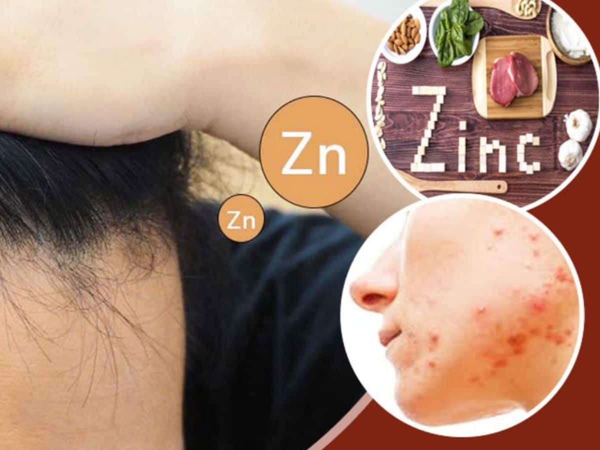Zinc Deficiency: 5 Unusual Signs That Indicates Severe Zinc Deficiency ...