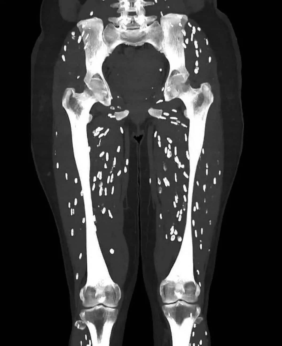 Doctor Shares Strange Image Of Person's Legs Infected With Parasitic ...