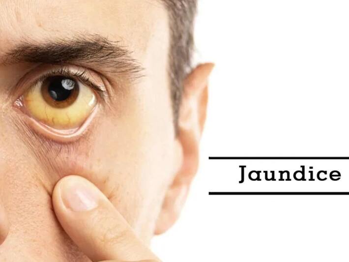 Fatty Liver Symptoms: 5 Facial Signs of Excessive Fat Accumulation In ...