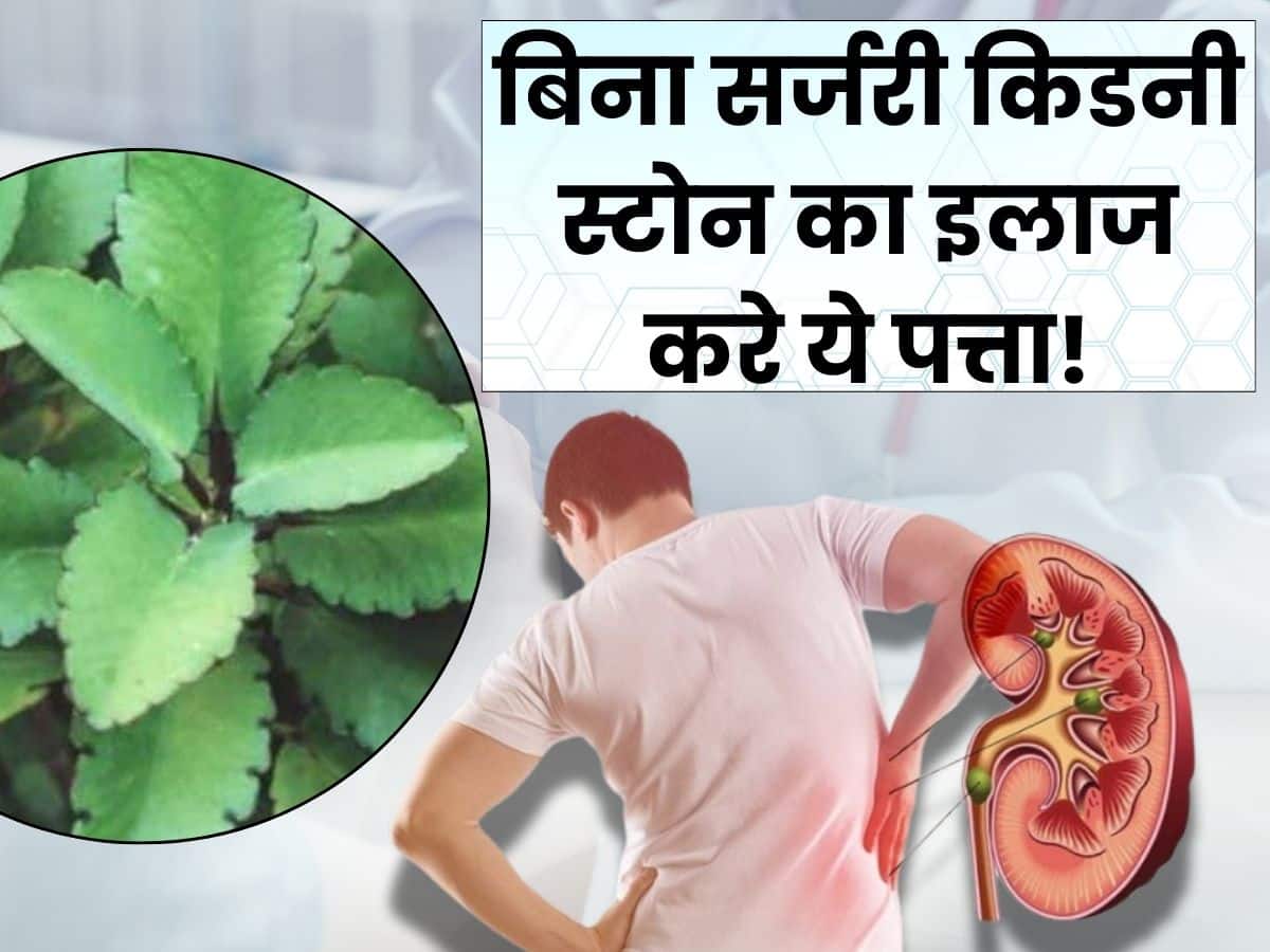 Kidney ki Pathri Kaise Theek Karen | बिना सर्जरी सालों पुरानी पथरी को ...