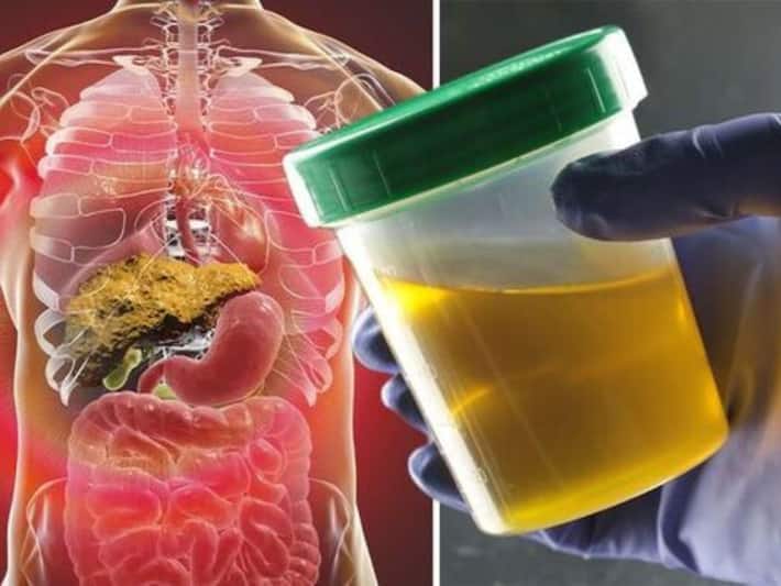 Excessive Foamy Urine At Night: 5 Potential Diseases That Can Cause ...