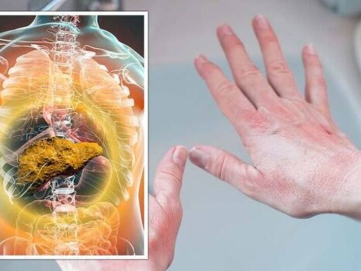 Fatty Liver Symptoms: 5 Facial Signs of Excessive Fat Accumulation In ...