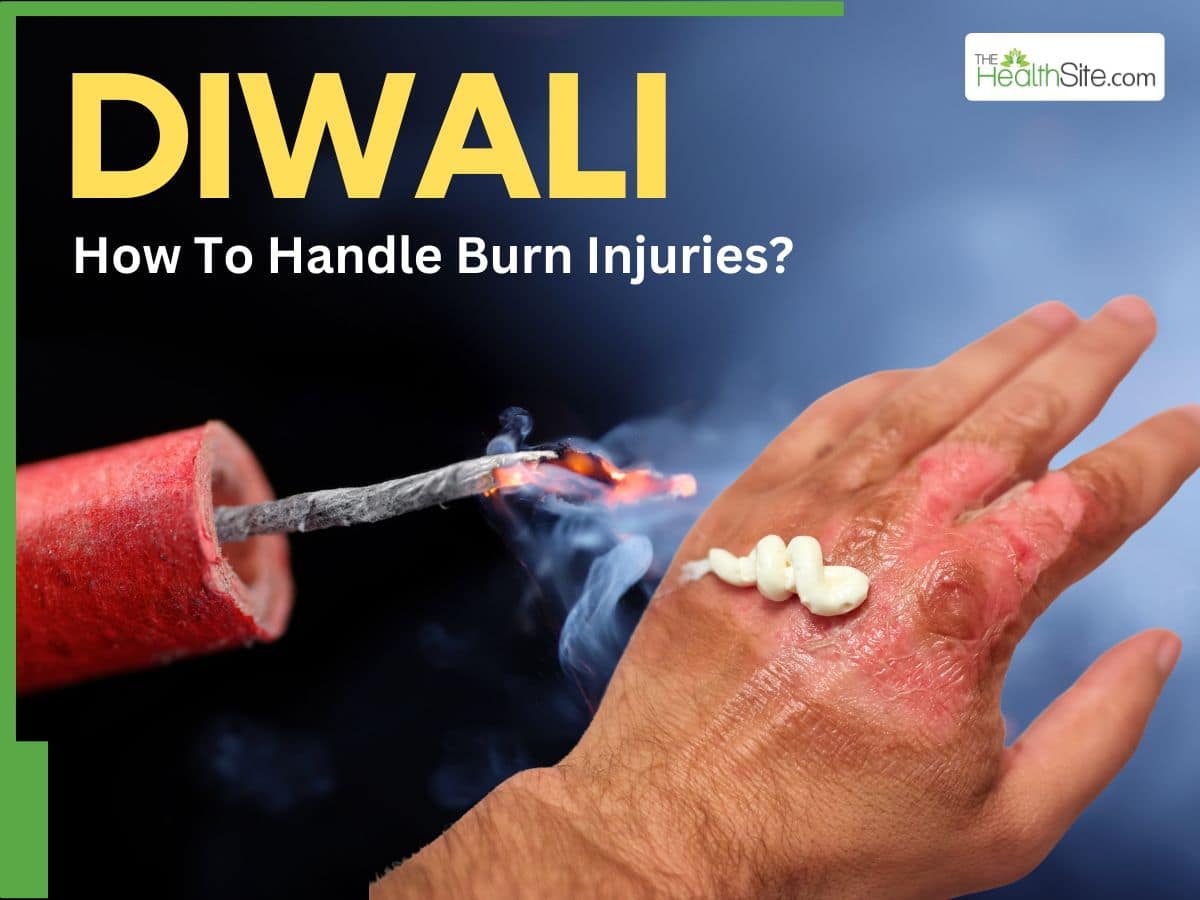Diwali Safety Tips: How to Treat Firecracker Burns and Injuries At Home ...