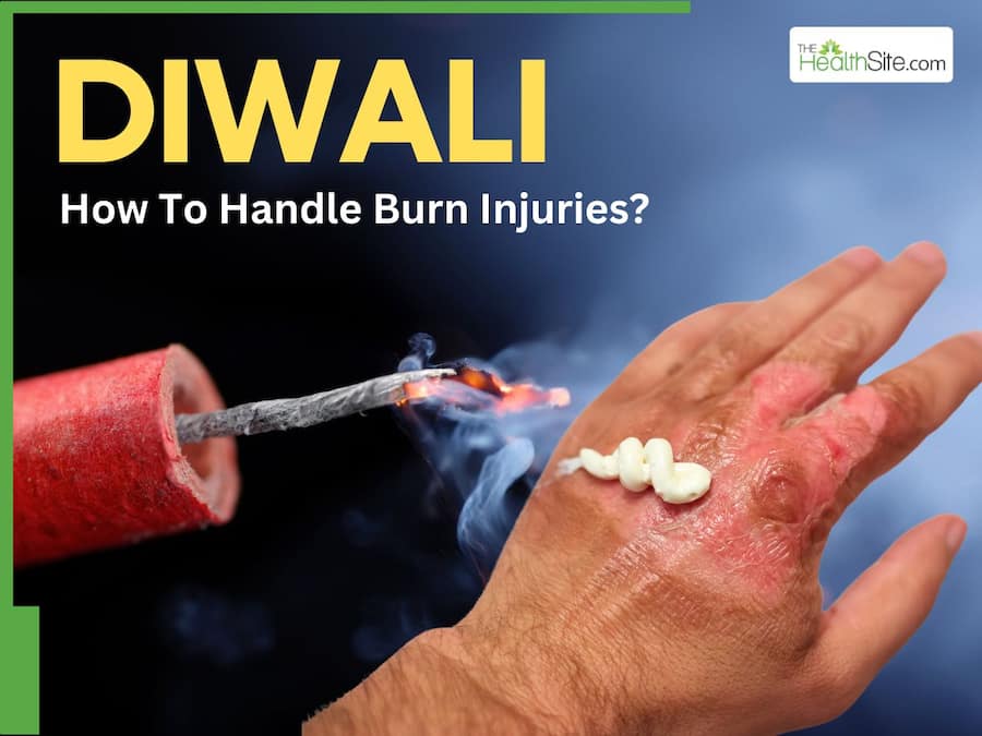 Diwali Safety Tips: How to Treat Firecracker Burns and Injuries At Home ...