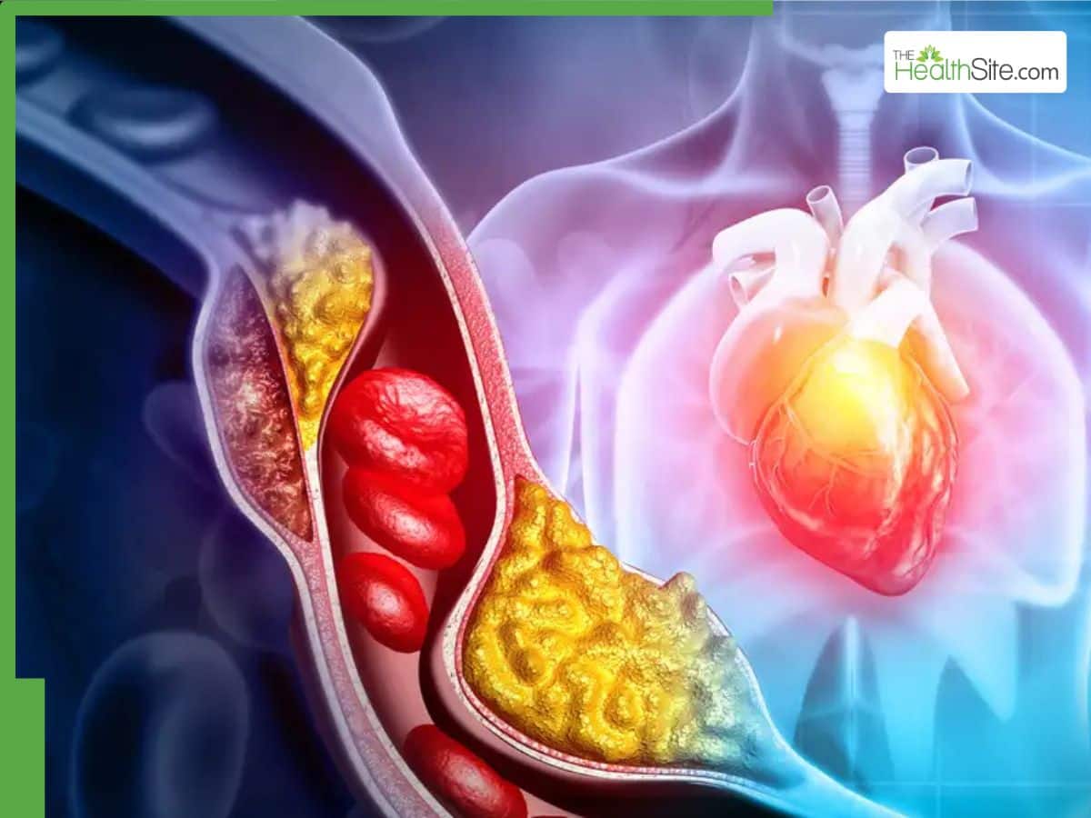 Heart Blockage Symptoms: 7 Signs of Blocked Arteries That May Appear At ...