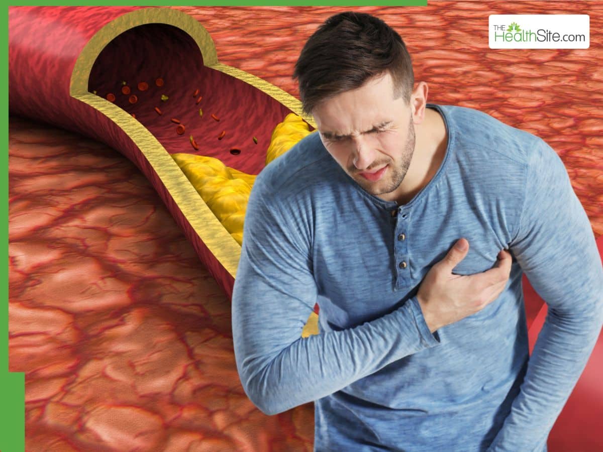 7 Superfoods To Prevent Plaque Formation In Arteries And Lower LDL ...