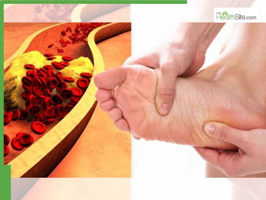 High Cholesterol Symptoms: 5 Unusual Signs of High LDL In Legs And Feet ...