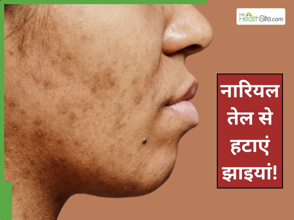 Jhaiya Kaise Hataye | झाइयां हटाने के लिए नारियल तेल में मिलाकर लगा लें ...