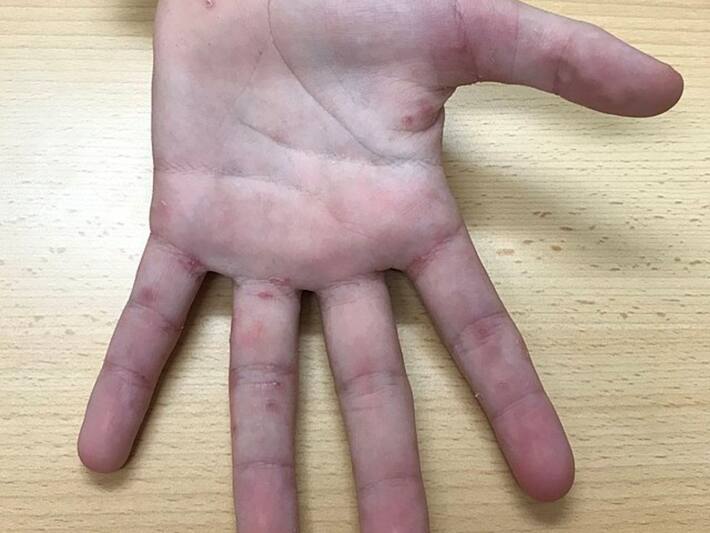 Scabies Cases Spike In The UK: Prevention, Warning Signs You Must Never ...