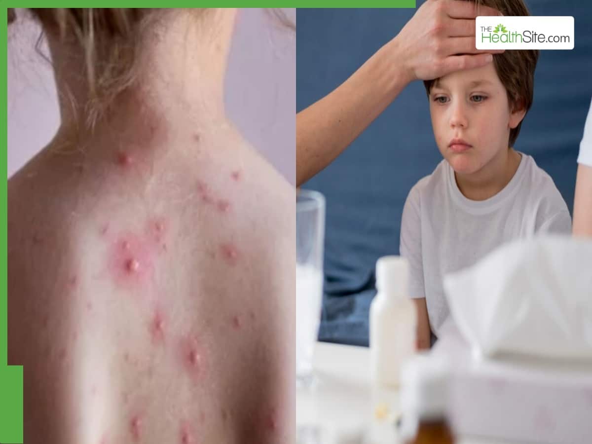 Mpox vs. Common Childhood Illnesses: Key Differences & Warning Signs to ...