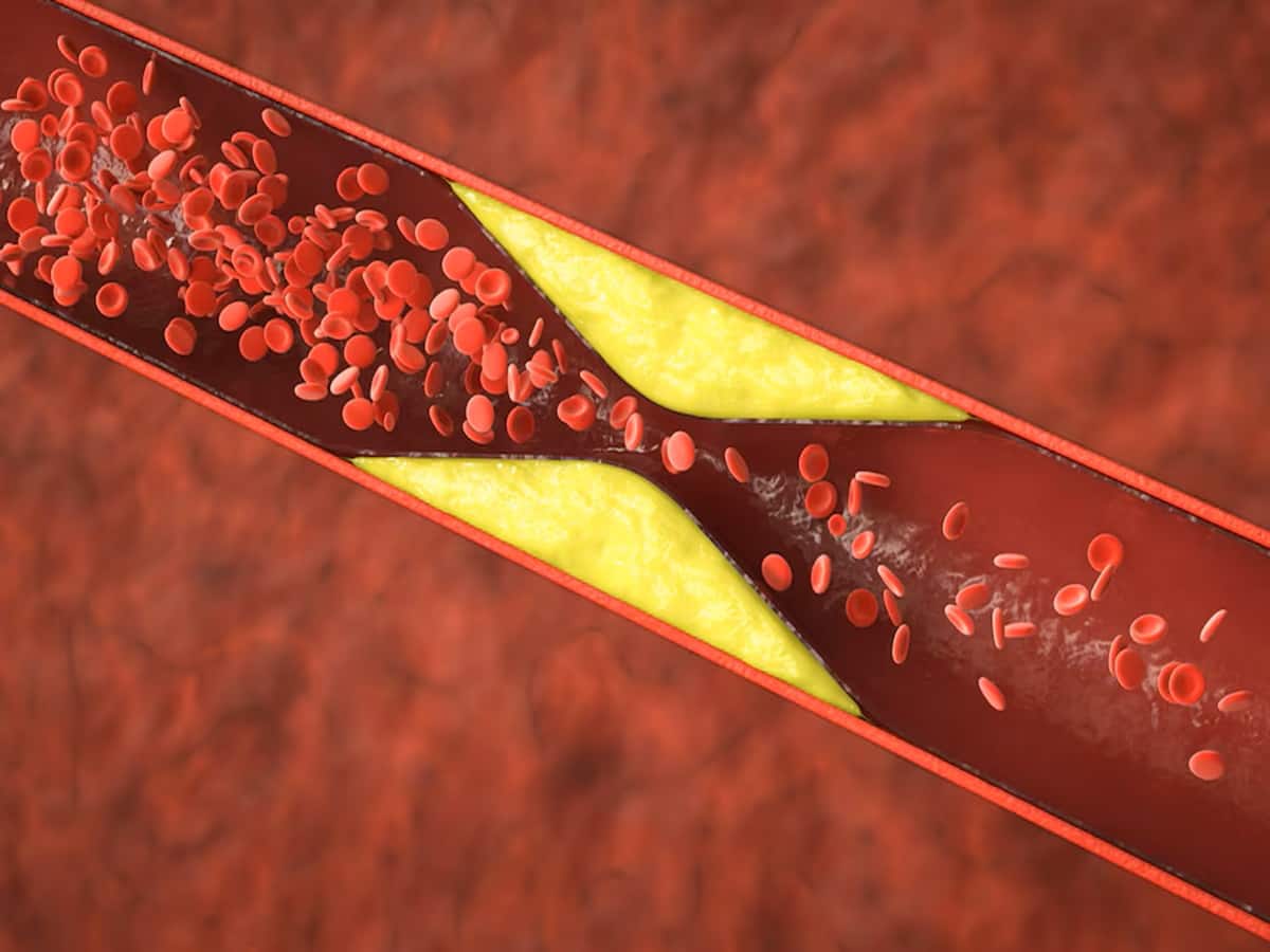 Tips To Prevent Clogged Arteries: Can Excess Intake Of Calcium ...