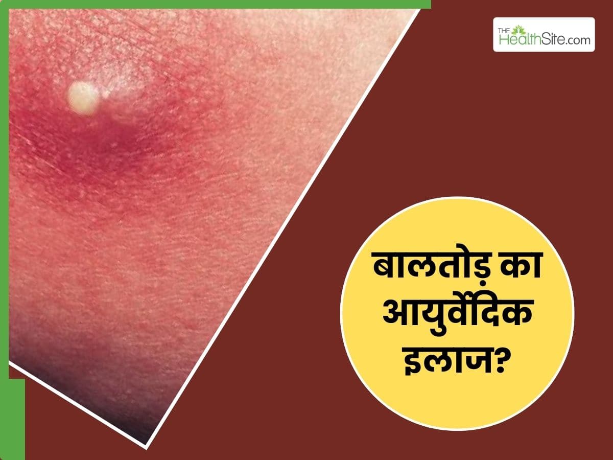 Baltod ka Ayurvedic Ilaaj | बालतोड़ होने पर अपनाएं ये 3 आयुर्वेदिक इलाज ...
