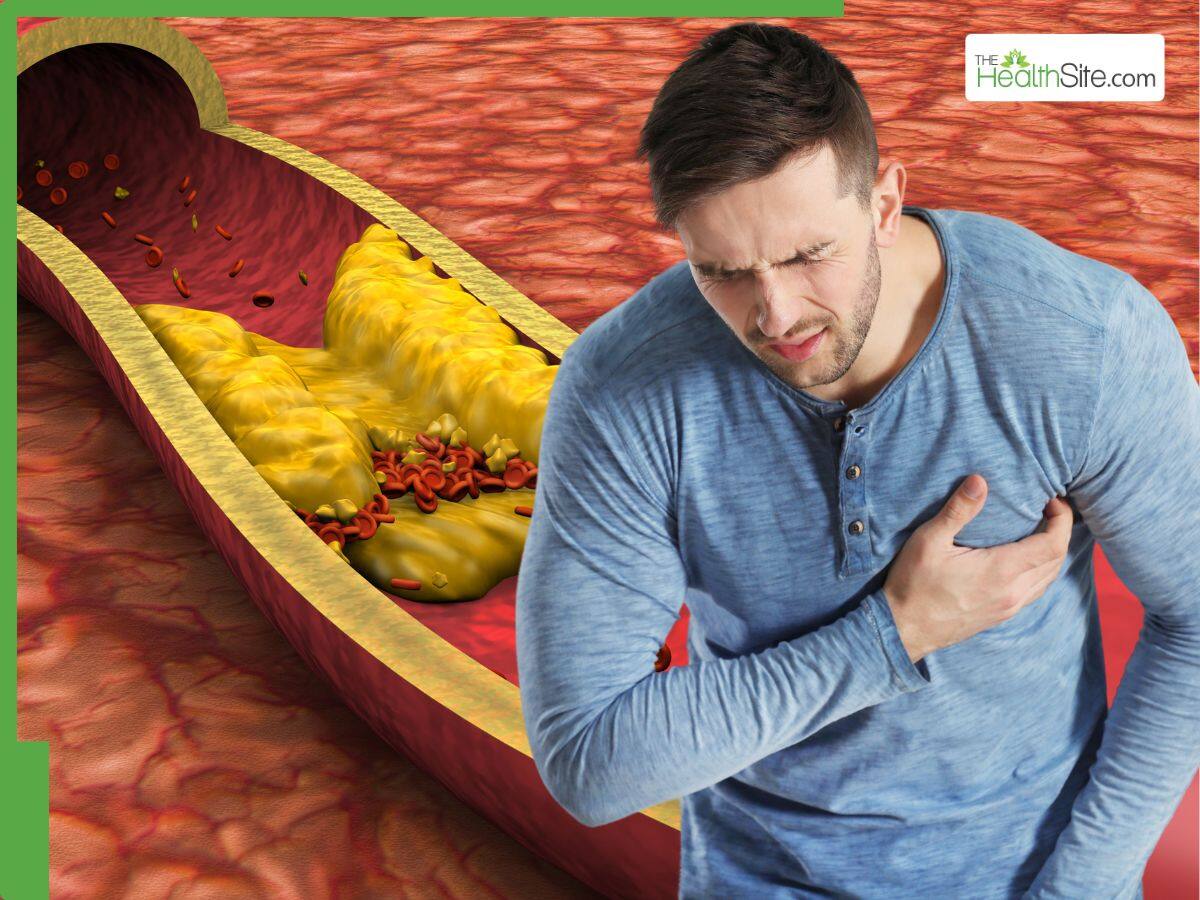 High Cholesterol Induced Heart Attack: 5 Yellow Superfoods To Clear ...