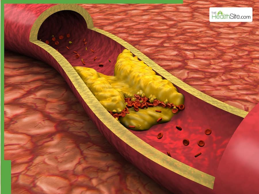 Clogged Arteries Diet Tips: 7 Nighttime Routine To Clear Plaque ...