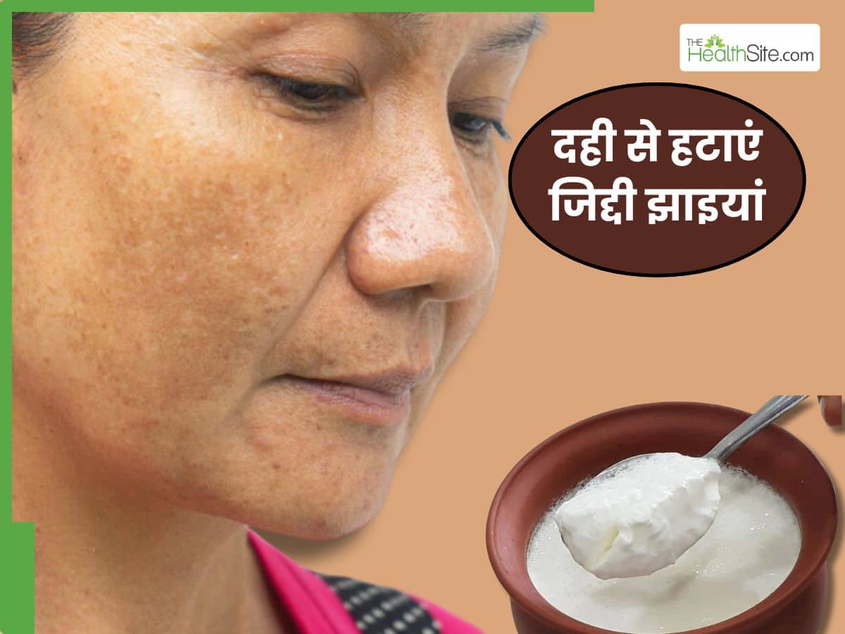 Jhaiya Kaise Thik Kare | गालों पर झाइयां हटाने के लिए दही का इन 3 ...