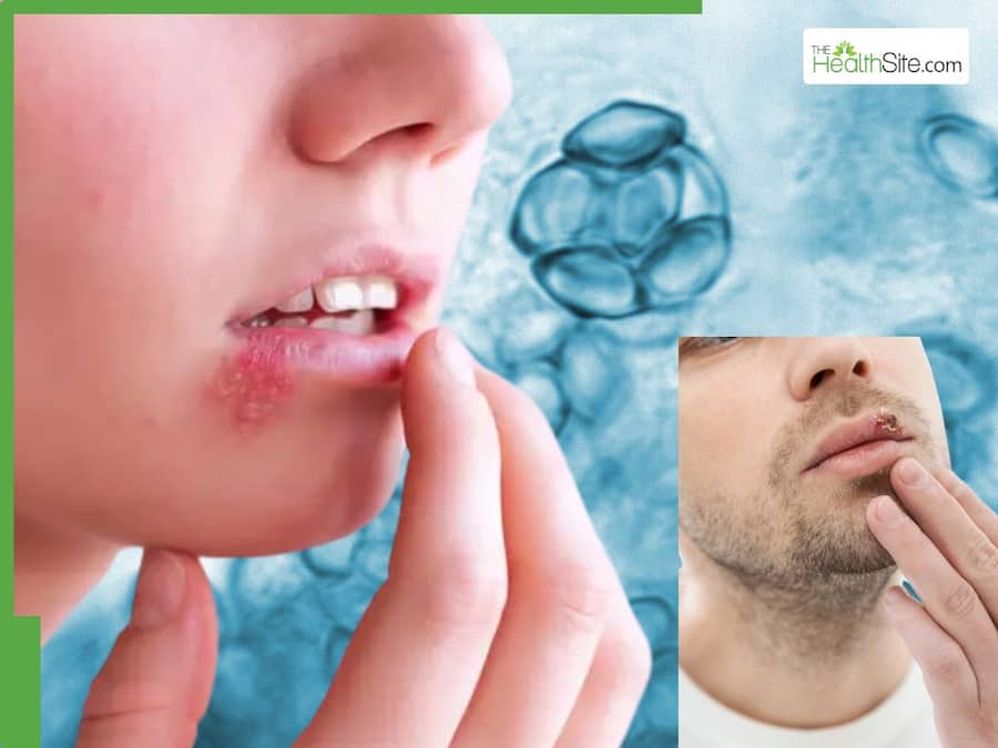 5 Unusual Signs of Sexually Transmitted Diseases (STDs) That May Show Up On Your Face ...