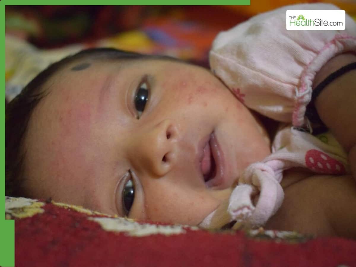 Atopic Dermatitis: Beware Of This Skin Condition That Causes A Lot Of ...