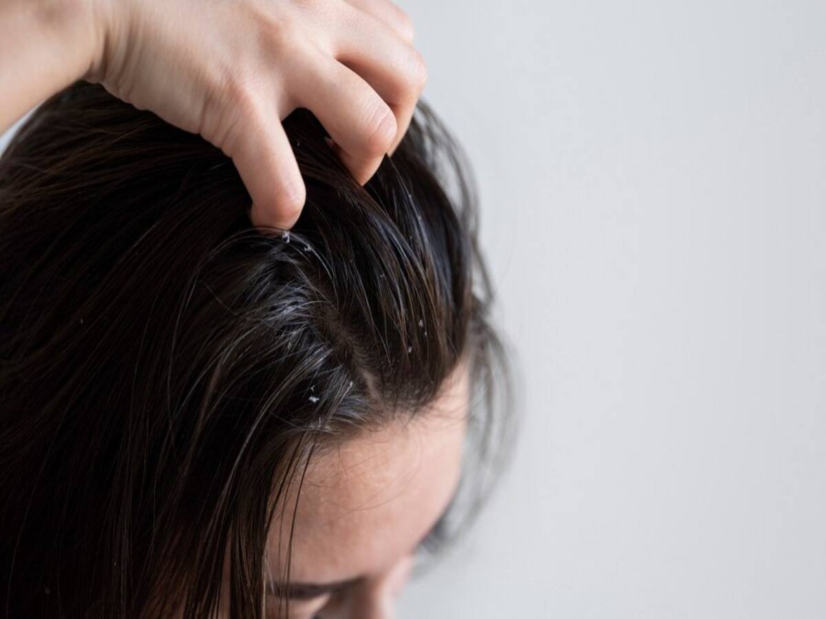 Winter Hair Care: How To Prevent Increasing Dandruff Problems In Cold ...