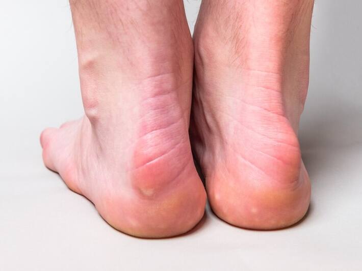 Do Not Ignore These 5 Major Signs In The Feet That Indicate Nutritional ...