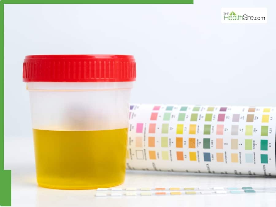 Foamy Urine: Is It A Sign Of A Serious Underlying Health Issue ...