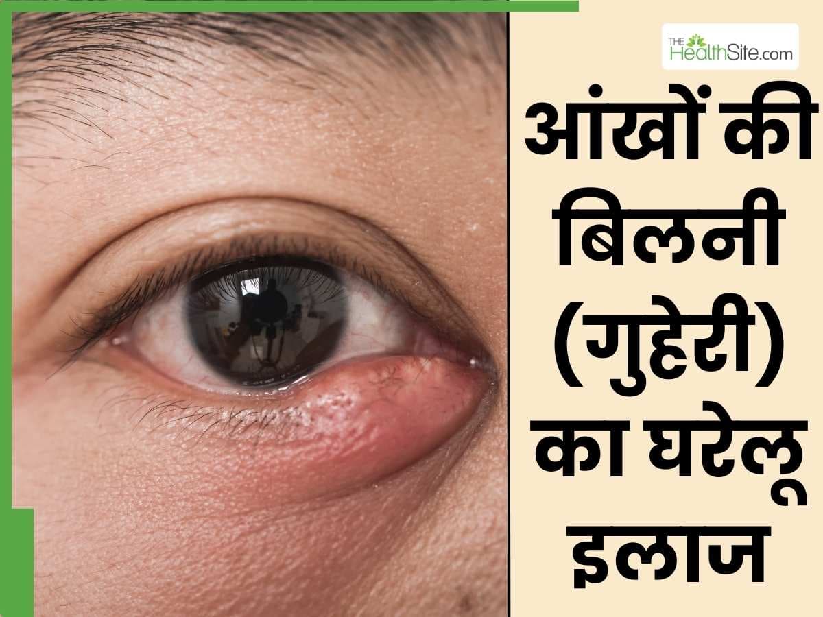 Aankho Me Bilni Ka Ilaj | आंखों की बिलनी (गुहेरी) को ठीक करने के लिए ...