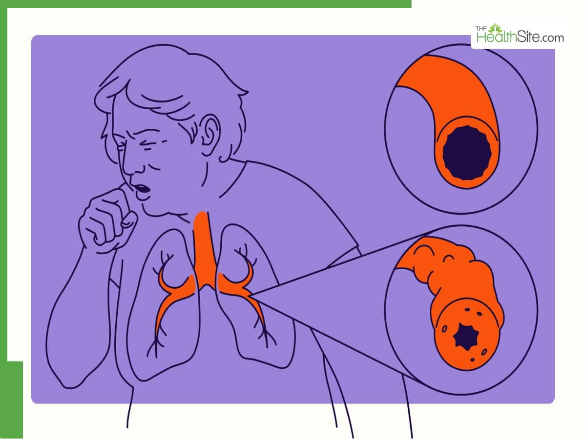 Understanding COPD: Early Detection And Prevention | TheHealthSite.com