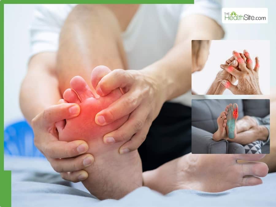 10 Signs Your Uric Acid Levels Have Gone Out of Control | TheHealthSite.com