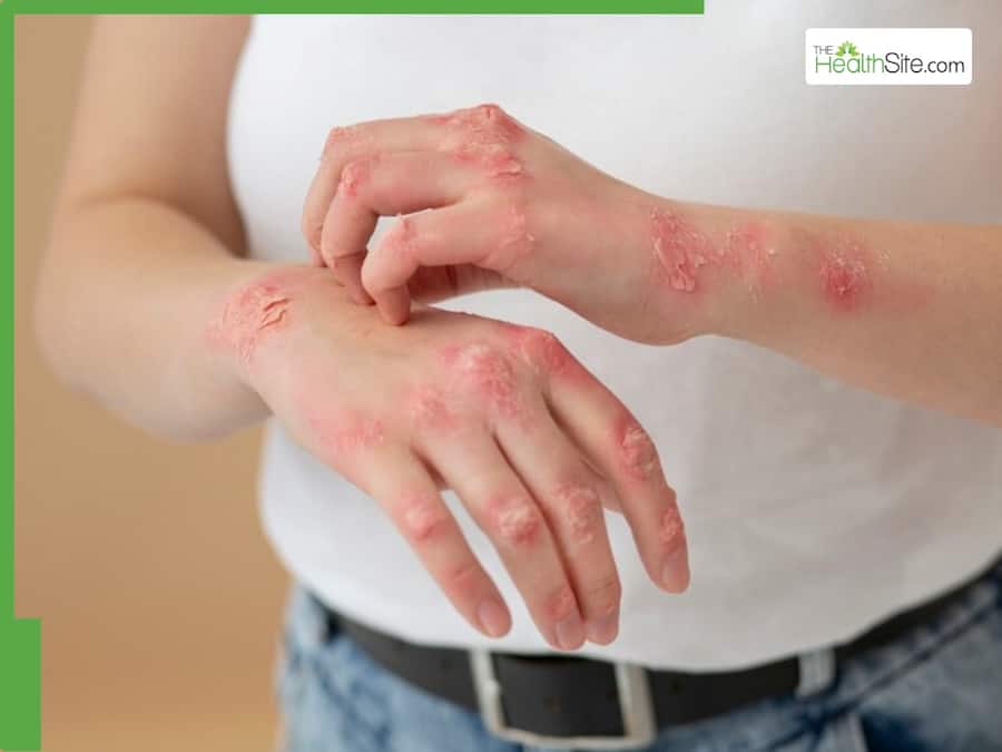 Dealing With Atopic Dermatitis In Winter: Cause, Symptoms, Treatment ...