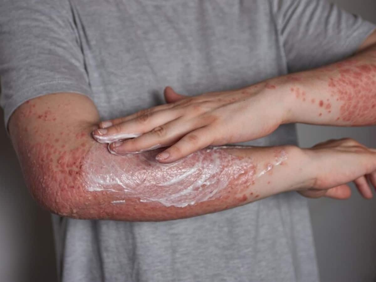 Dealing With Atopic Dermatitis In Winter: Cause, Symptoms, Treatment ...