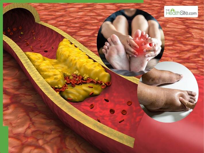 Clogged Arteries Symptoms: 7 Unusual Signs of Heart Blockage That Appear In Legs And Feet ...