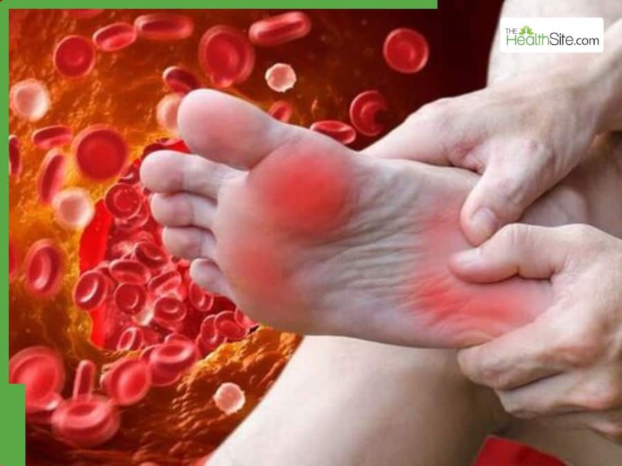 High Cholesterol Symptoms: 10 Signs of High LDL Cholesterol In Legs And ...