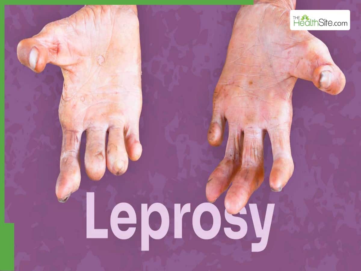 Understanding Leprosy: Symptoms, Transmission, And Treatments Available Today | TheHealthSite.com