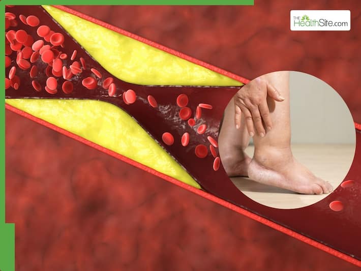 Clogged Arteries Symptoms: 7 Unusual Signs of Heart Blockage That ...