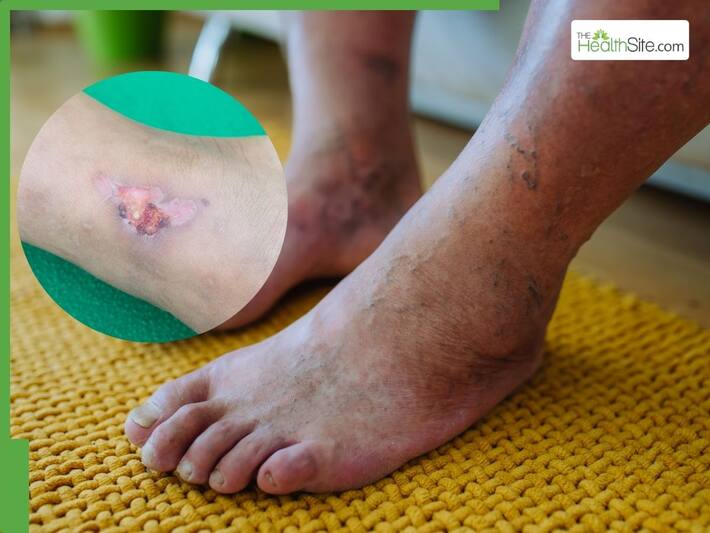 Clogged Arteries Symptoms: 7 Unusual Signs of Heart Blockage That ...