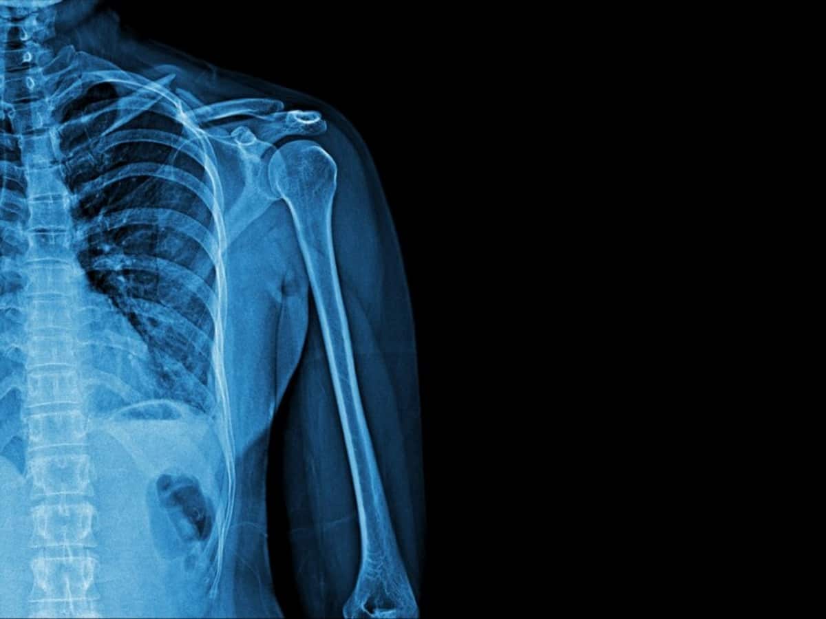 Shoulder Dislocation: Understanding The Severity Of The Injury And Its ...