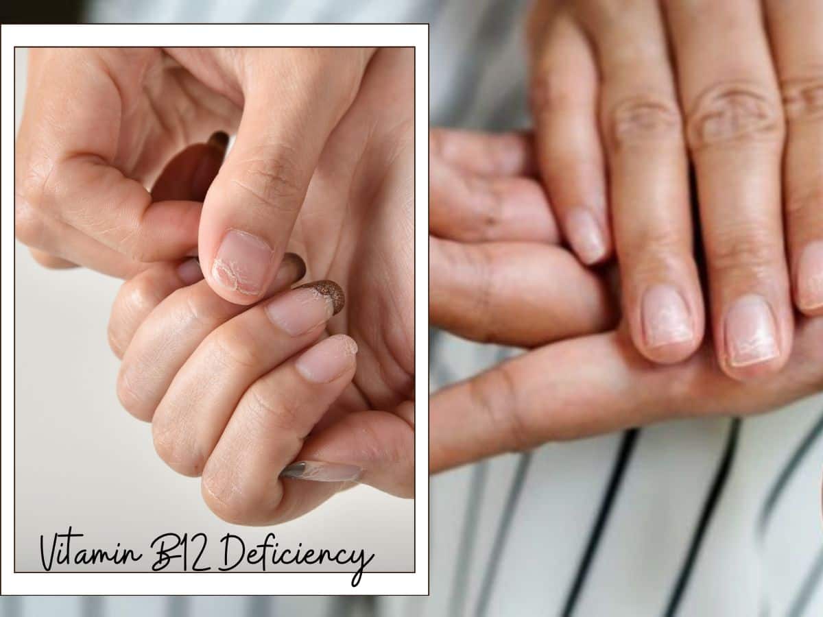 10 Warning Signs of Vitamin B12 Deficiency That Appear On Your Nails ...