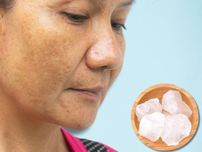 Fitkari Se Jhaiya Kaise Hataye | फिटकरी से झाइयां कैसे हटाएं? जानें 5 ...