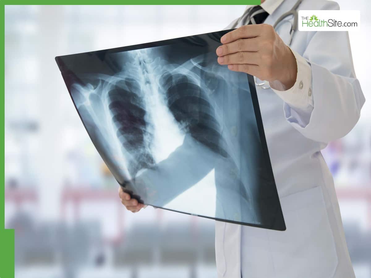 Latent Vs Active Tuberculosis: Key Differences Explained ...