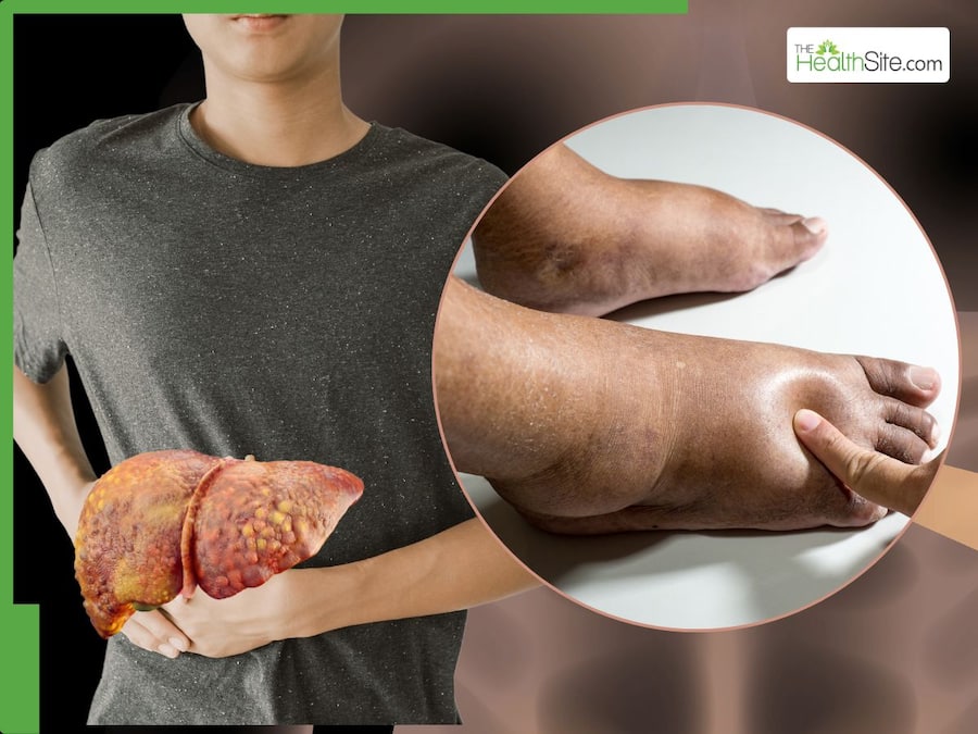 Alcoholic Liver Cirrhosis: 5 Warning Signs Your Feet May Show When Your ...