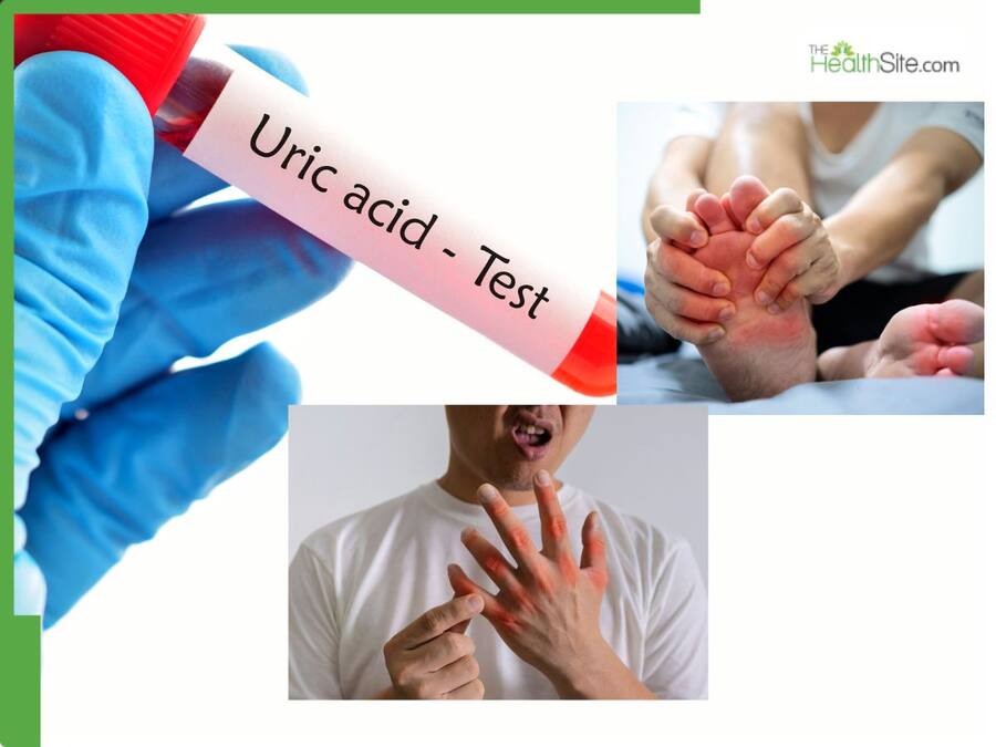 High Uric Acid Symptoms That Strike Mostly at Night: Why Mid Night Pain ...