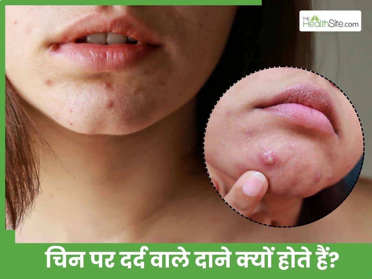 Chin Par dard Wale Pimple Kaise Thik Hota Hai: डॉक्टर ने बताया ठोड़ी के ...