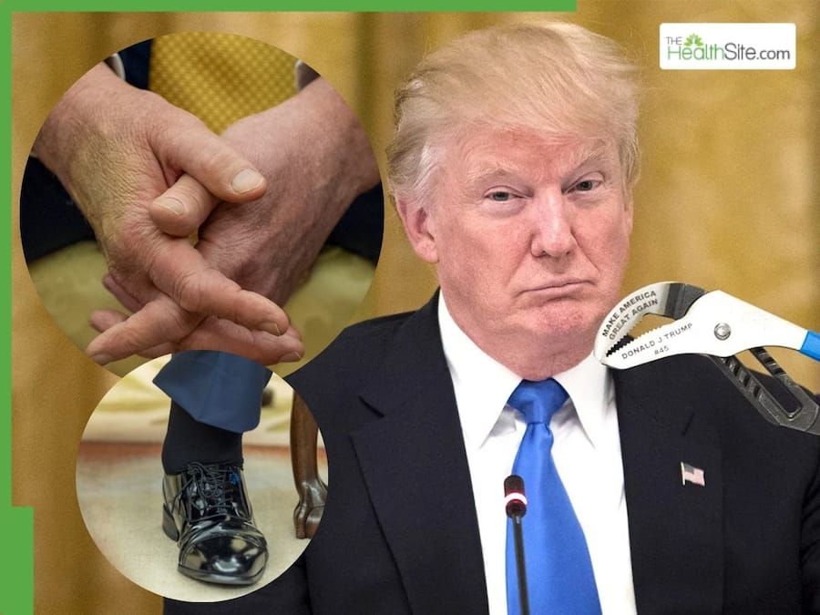 US President Donald Trump’s Swollen Leg Symptom Points Finger To 4 ...