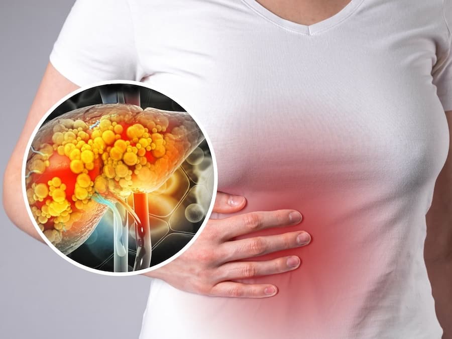 Fatty Liver Side Effects: Warning Signs in Your Hands That Could Reveal ...
