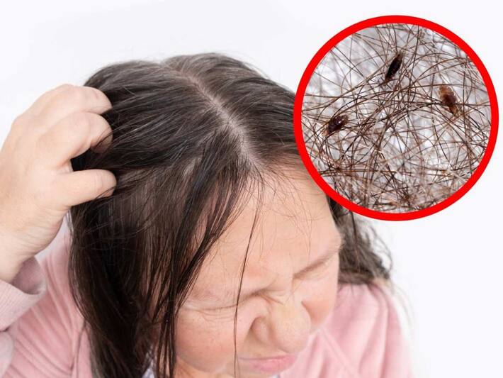 Joo Marne Ke Gharelu Upay | बालों में जूं की समस्या से हैं परेशान? रसोई में मौजूद इन 5 घरेलू ...