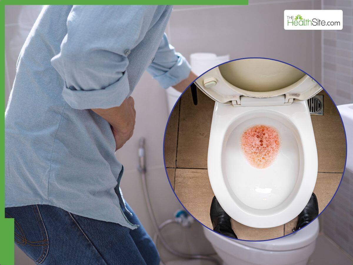 Blood in Urine Causes: Is Hematuria a Warning Sign of Cancer or ...