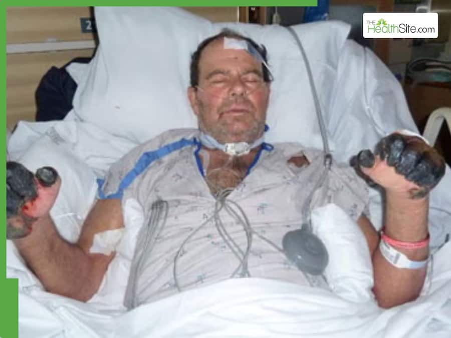 Black Death Plague Sweeps Through US: Blackened Skin, Rotting Flesh And ...